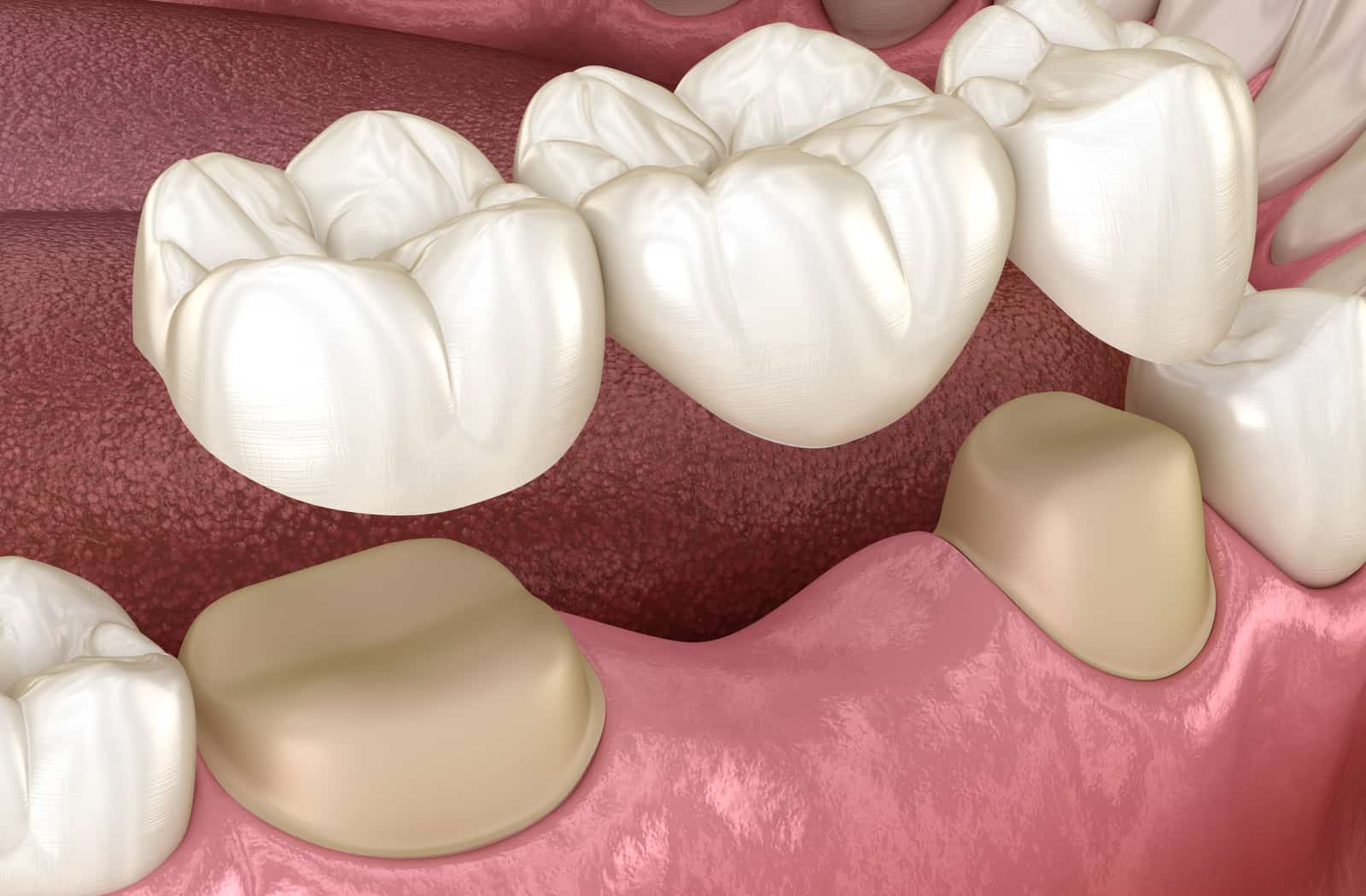 How Does a Dental Bridge Work? | London, ON